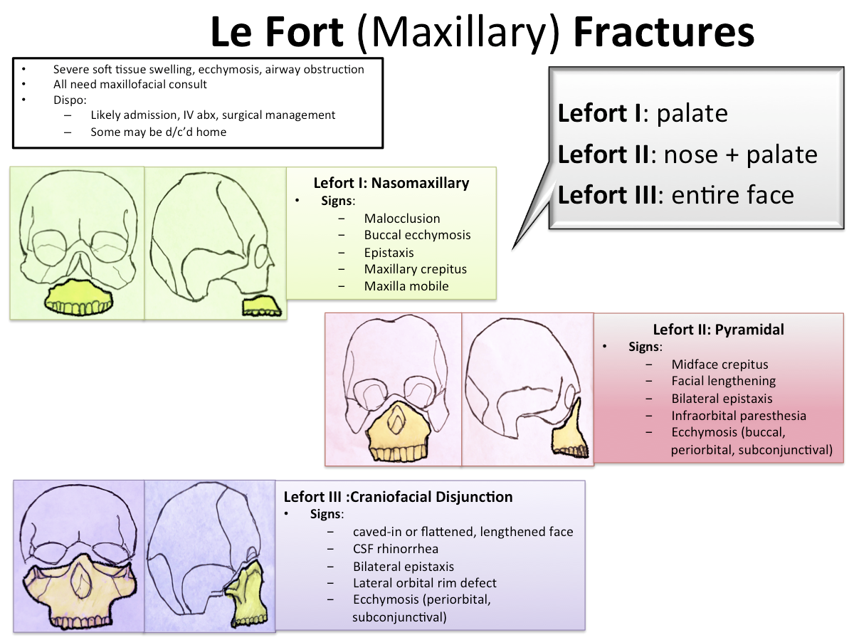 Le Fort Fractures – Verpleegkundig specialisten Spoedeisende hulp