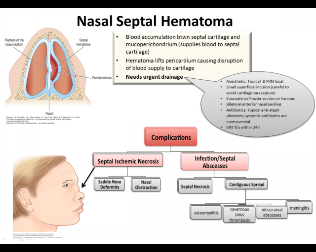 Hematoma Septal Nasal Nasal Septal Hematoma Drainage: Overview,