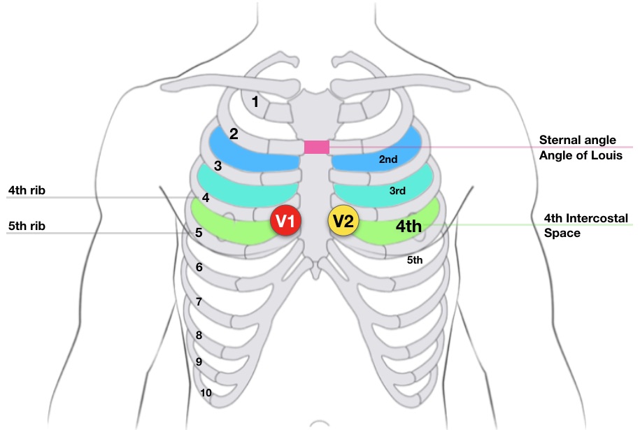 Misplacement of V1 and V2 – Verpleegkundig specialisten Spoedeisende hulp