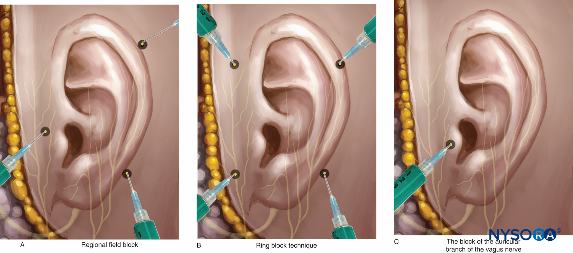Nerve Blocks of the Face – Verpleegkundig specialisten Spoedeisende hulp